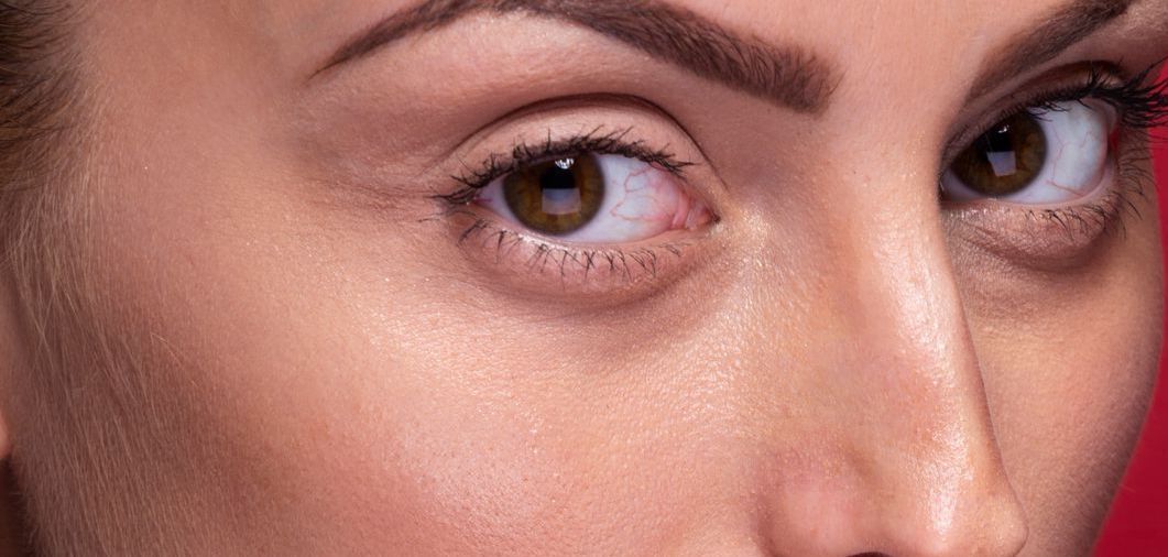 Eye Bag Solutions Without Surgery | Harrogate